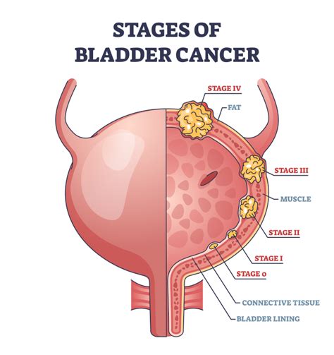 Understanding Bladder Cancer Urologic Surgery Of Nwi