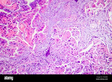 Photomicrograph Of Squamous Cell Carcinoma Of The Lung Showing Malignant Squamous Cells In Lung