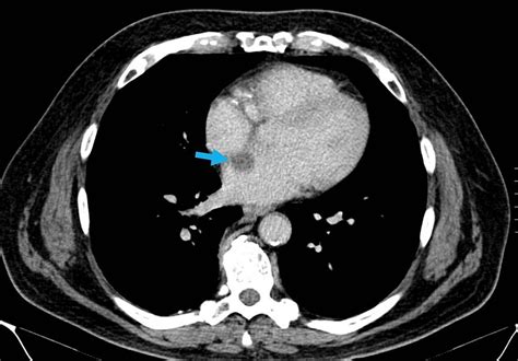 Ct Urogram Showing An Incidental Partially Visualized 21 Cm Round
