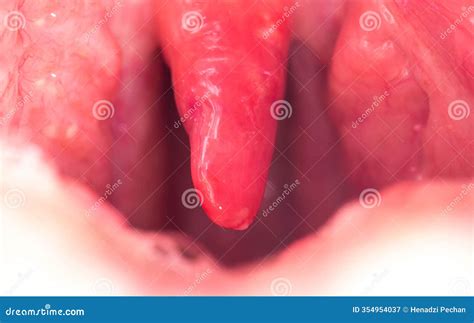 Long Uvula With Inflammation Of Infections And Viruses Treatment Of
