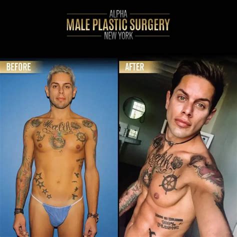 Abs Implants Before And After Male Plastic Surgery Los Angeles