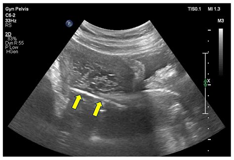 Molar Pregnancy Early Diagnosis Clinical Management And The Role Of
