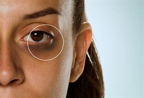 What Is Hyperpigmentation