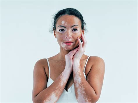 Understanding Vitiligo And What Happens Within The Skin