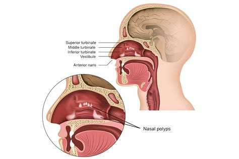 Nasal Polyps Dr Aykut Unsal Philadelphia