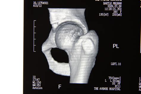Meghans Periacetabular Osteotomy Journey Imaging