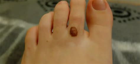 Melanoma On Foot Signs Risks And Early Detection