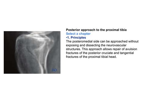 Proximal Tibia Approach Pptx