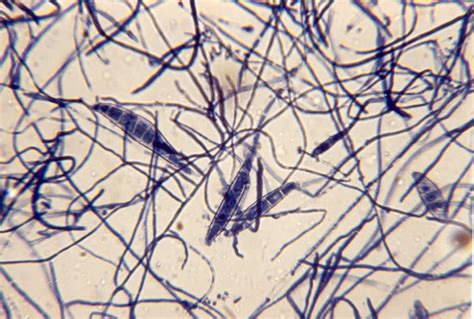 When Do We Have To Perform A Fungal Culture