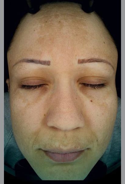 Before And After Hyperpigmentation Dr Nguyen Health Center