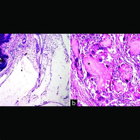 Pdf Bullous Pilomatricoma A Stage In Transition To Secondary Anetoderma