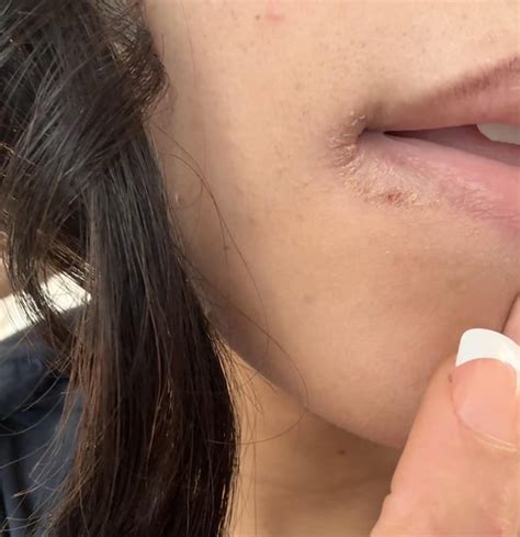 Angular Cellulitis R Medical Advice