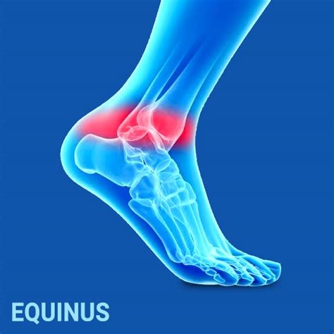 Equinus Footmap