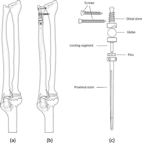 3d Representation Of Wrist And Druj Prosthesis And Their Components Download Scientific