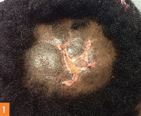 Whats Causing Scalp Lesions And Hair Loss In A Pair Of Young Patients Consultant360