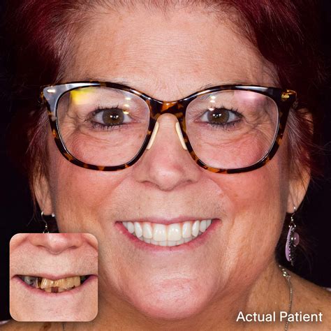 Full Mouth Dental Implants Dallas Tx Doctors Implants