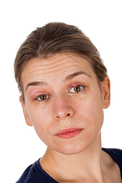 Swollen Upper Eyelid Swollen Upper Eyelid Bet Yonsei Ac Kr Hot Sex