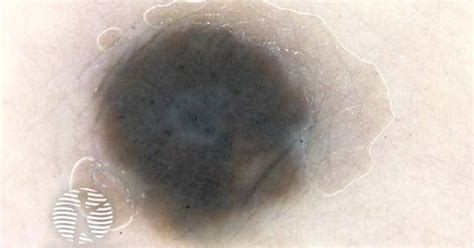 Dermoscopy Dotted Pattern Image