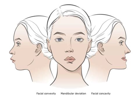 Smartee Mandibular Repositioning Device Cost And Technology Mrd Sleep Apnea