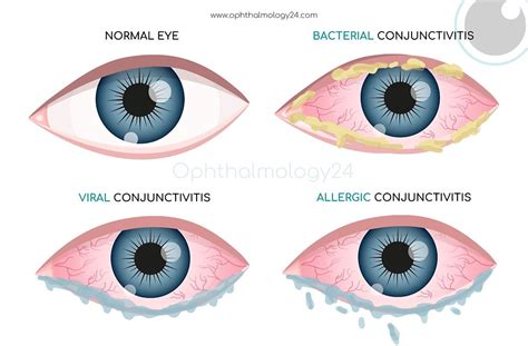 Bacterial Conjunctivitis Pediatric Acute Bacterial Conjunctivitis An