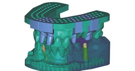 Exocad Ideas To Save Today Dental Restoration Dental Technician Bar Module And More