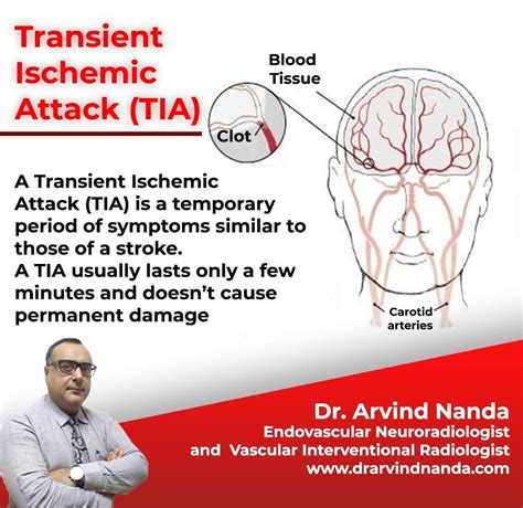 Transient Ischemic Stroke Symptoms