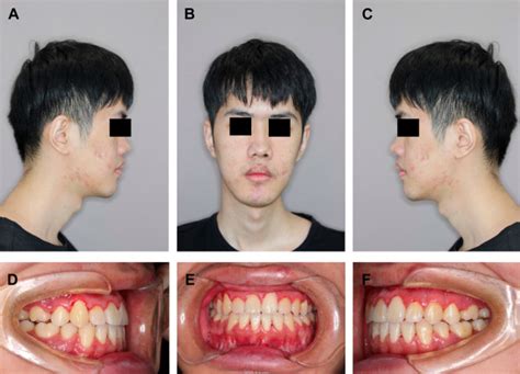 Surgical Management For Vertical Maxillary Excess Oral And