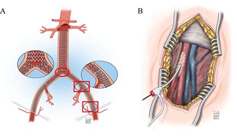 Comparison Of Aortobifemoral Bypass To Aortoiliac Stenting With