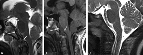 Tectorial Membrane Mri