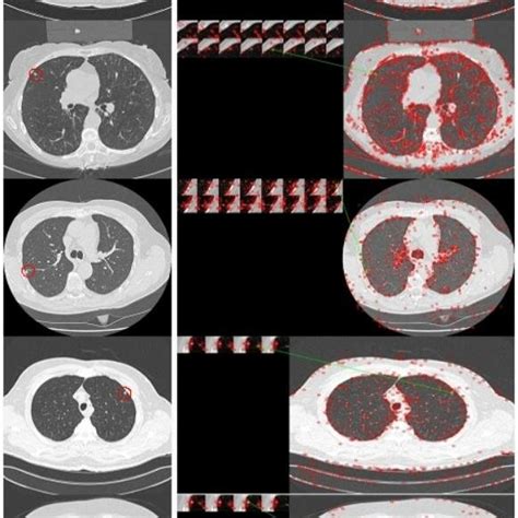 the detected and matched nodule features obtained using sift flann