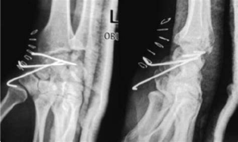 Postoperative Radiographs Showing Anatomical Reduction And Internal Download Scientific Diagram