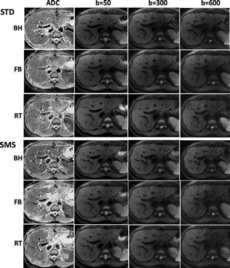 Comparisons Of Image Quality Of Std Dwi The Upper Three Rows And