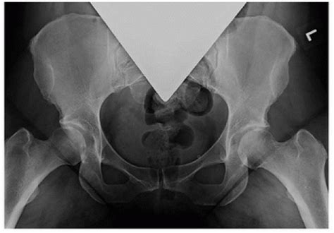 Periacetabular Osteotomy Musculoskeletal Key