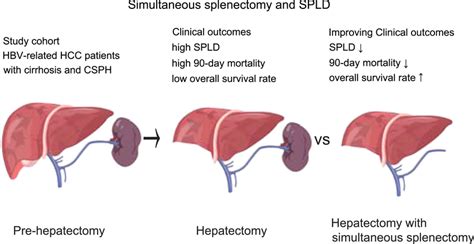 Simultaneous Splenectomy Improved Outcomes Of Hcc Patients With