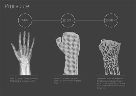 Cortex 3d Printed Cast For Fractured Bones By Jake Evill