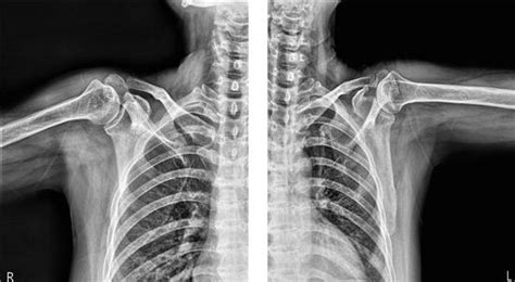 극상근증후군 어깨 통증이 지속되는 분 필독 네이버 블로그