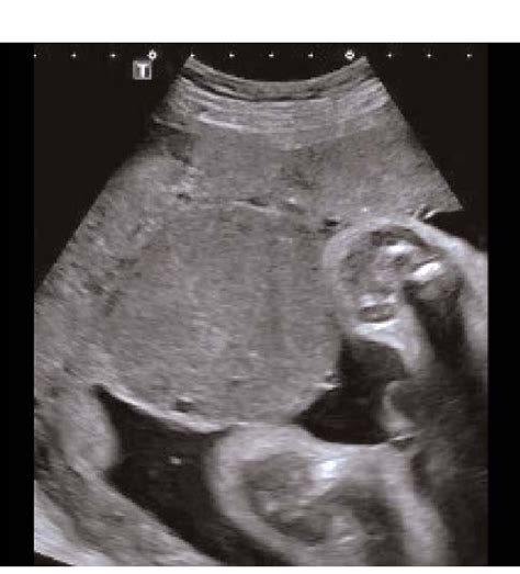 Homogeneously Hypoechoic Solid Type Placental Mass Without Images