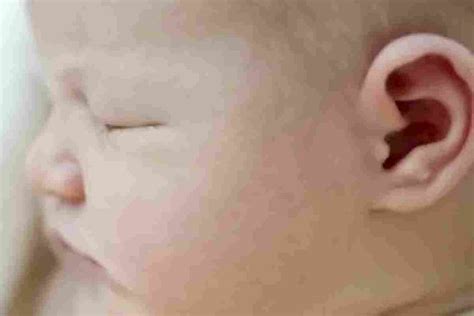 Баланопостит у дітей симптоми лікування