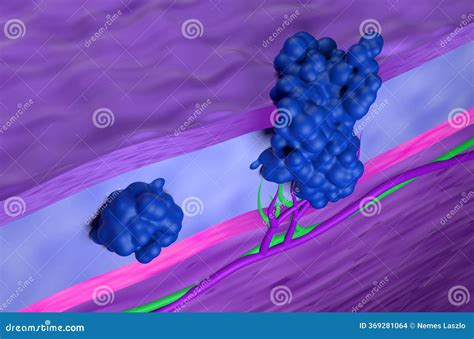 Benign Vs Malignant Tumors Isometric View 3d Illustration Royalty