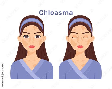Chloasmaisolated Beautiful Brunette Woman Cute Face Skin Diseasetreatmentwoman With Open