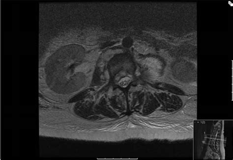 Mri Lumbar Spine Showing A Discitis At L34 With An Epidural Abscess