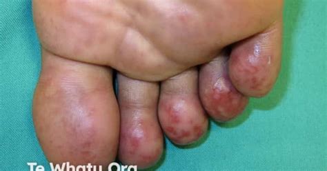 Chilblains 018 V2 Image