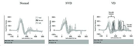 Vhit Traces Of Horizontal Leftward Head Impulses Demonstrating Normal Download Scientific