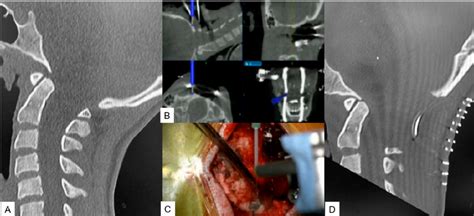 Case 2 14 Years Old Female Chiari Malformation Foramen Magnum Download Scientific Diagram