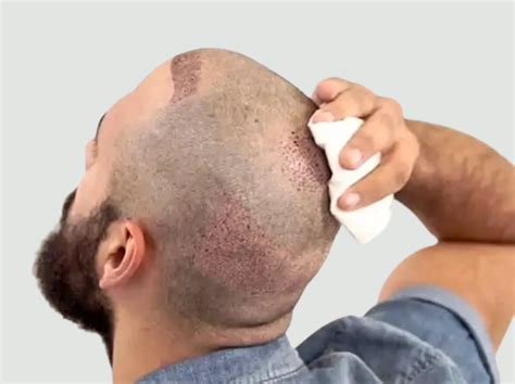 Shedding After Hair Transplant Temporary Phase Or Cause For Concern