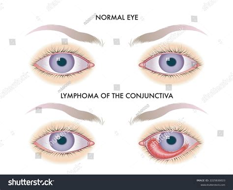 Medical Illustration Compares Healthy Eye One Stock Illustration