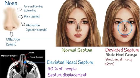 Deviated Septum Symptoms Treatments And Causes Nasal Septal