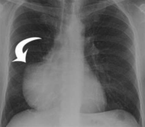 Diagnosing Foundation For Thymic Cancer Research