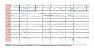 Benign Variants Of Eeg PPTX
