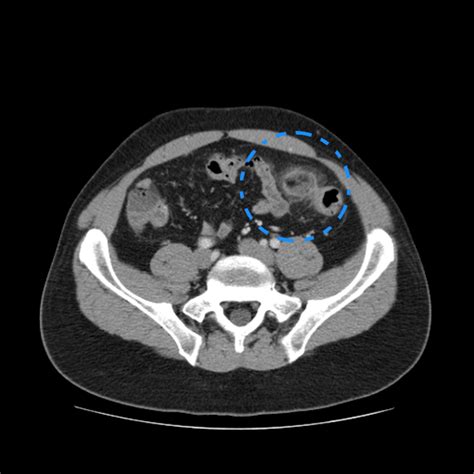 Epiploic Appendagitis Treatment